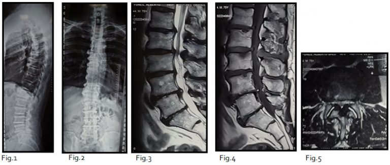 Lumbar Tubular Decompression Through An Interspinous Midline Approach ...