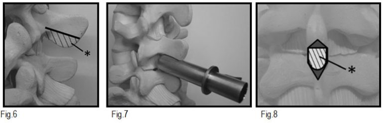 Lumbar Tubular Decompression Through An Interspinous Midline Approach ...